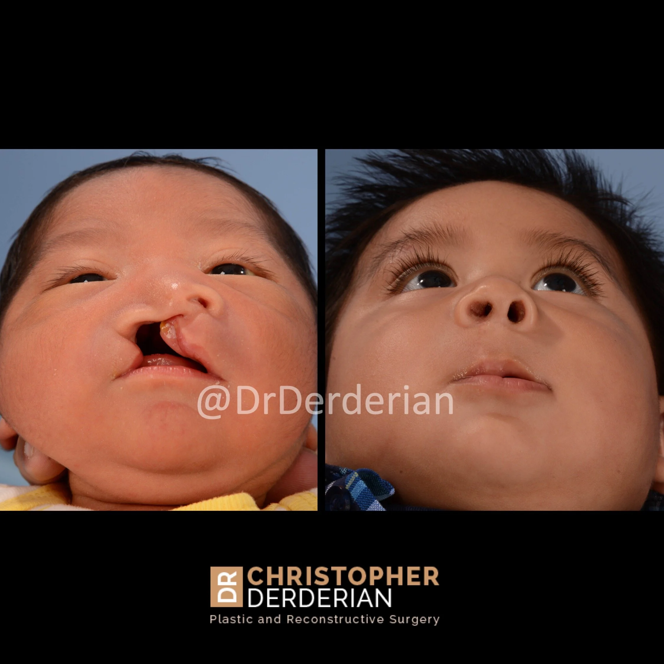 Cleft Rhinoplasty — Dallas Plastic Surgeon specializing in Rhinoplasty ...