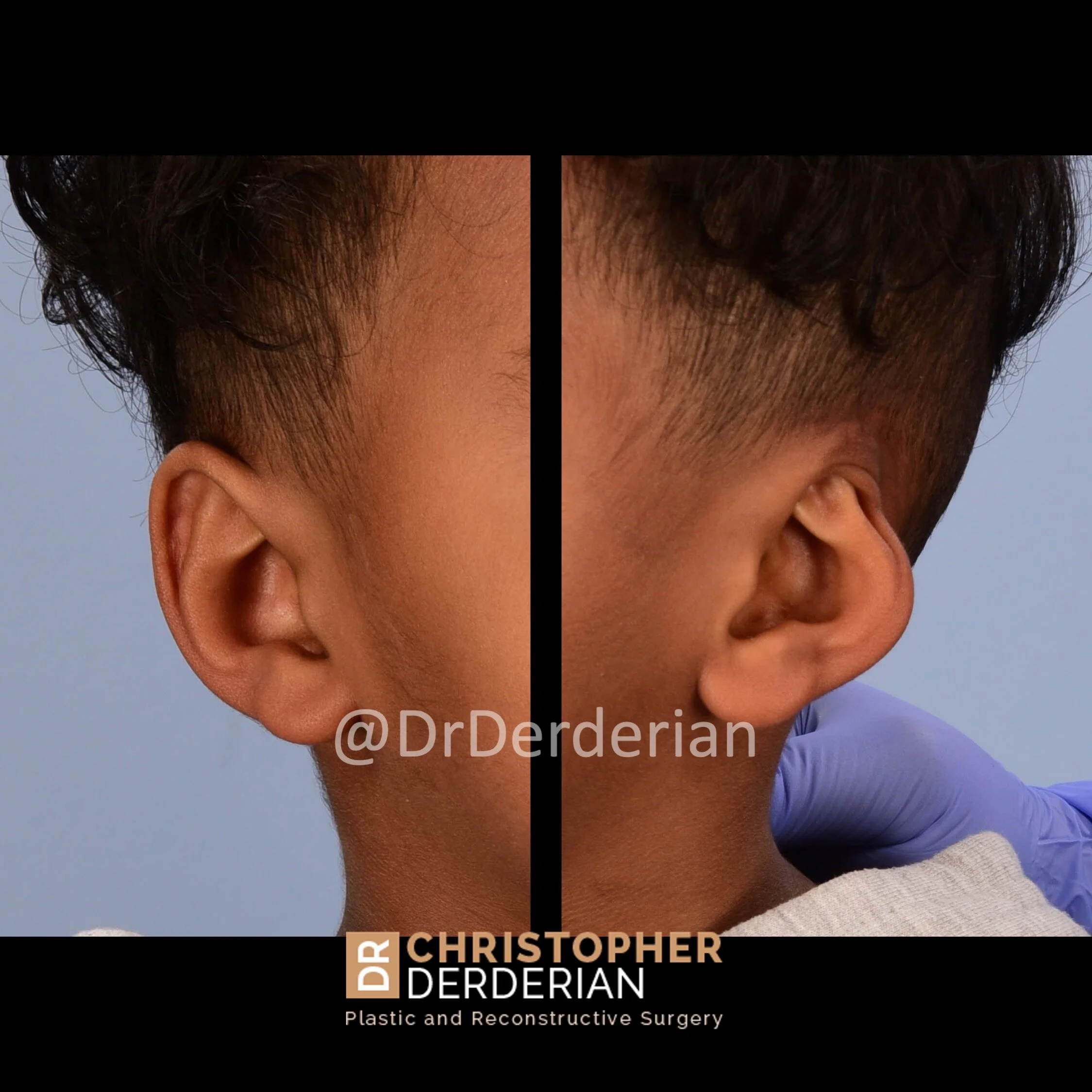 Cryptotia — Dallas Plastic Surgeon specializing in Rhinoplasty ...