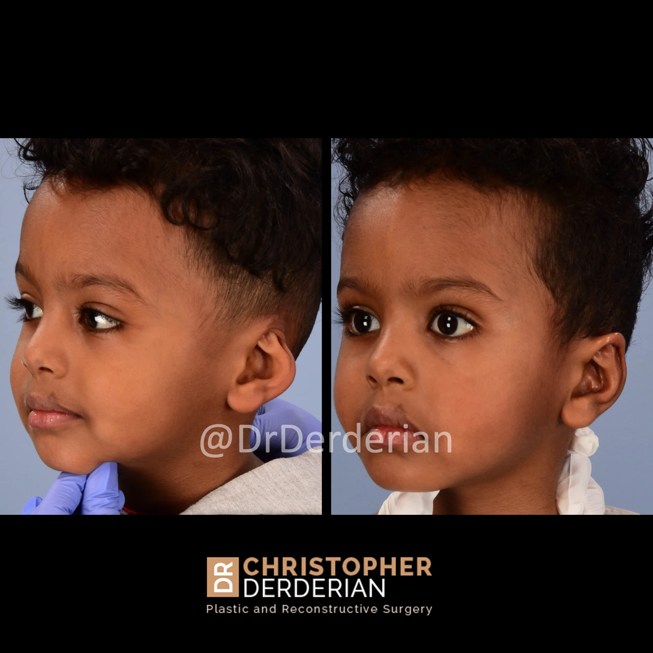 Cryptotia — Dallas Plastic Surgeon specializing in Rhinoplasty ...