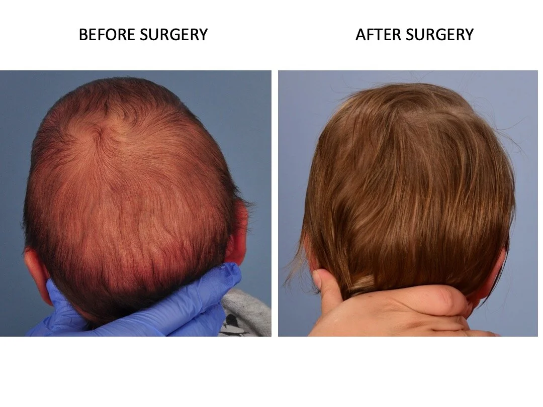 Minimally Invasive (Endoscopic) Sagittal Strip Craniectomy Before and ...