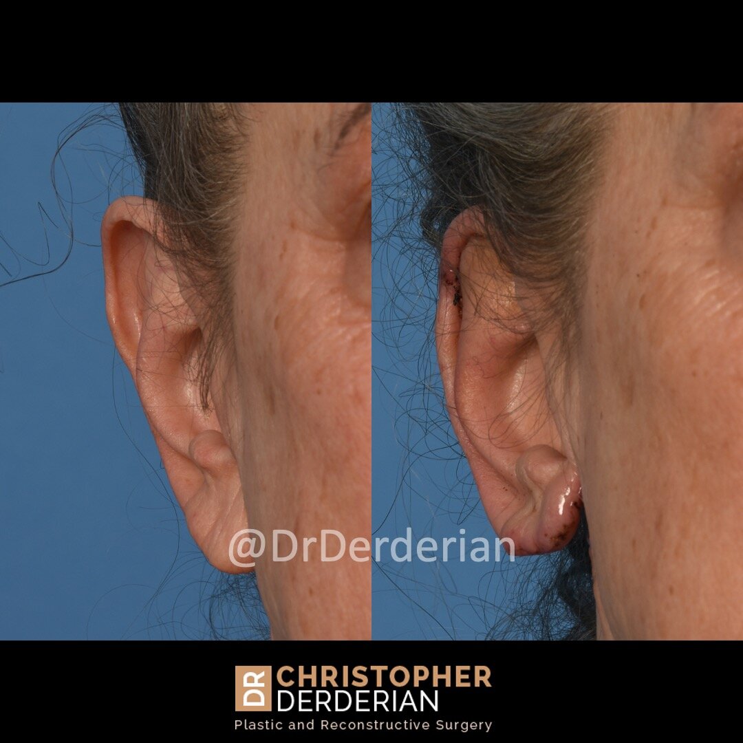 Dallas Ear Reduction Surgery (Reduction Otoplasty) — Dallas Plastic ...
