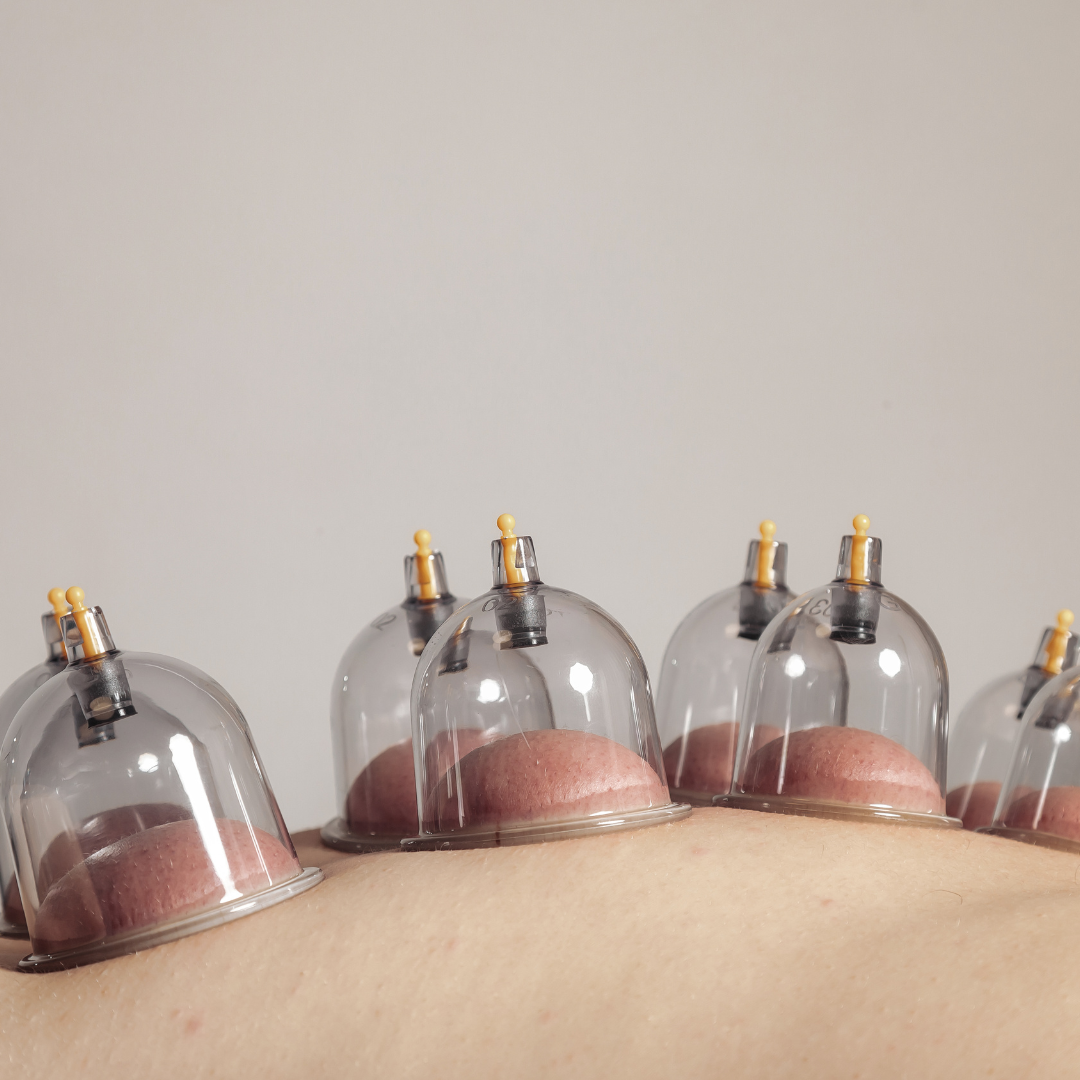 Best Cupping Therapy Practices in Columbus, Ohio — The Winchester ...