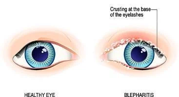 Midtown Optometry - Blepharitis —Causes, Symptoms & Treatment Options