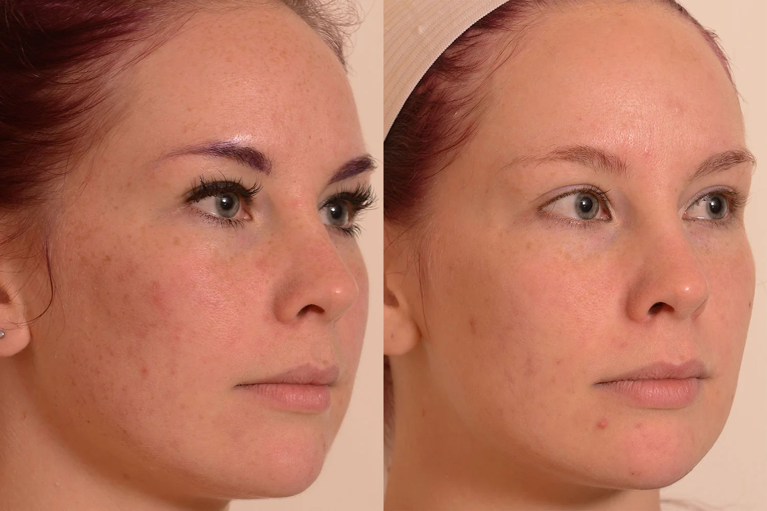 Sun Damage — Tahoe Aesthetic Medicine