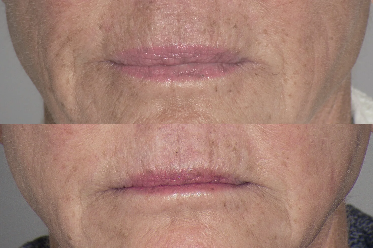 Lumps, Bumps, and Lines — Tahoe Aesthetic Medicine