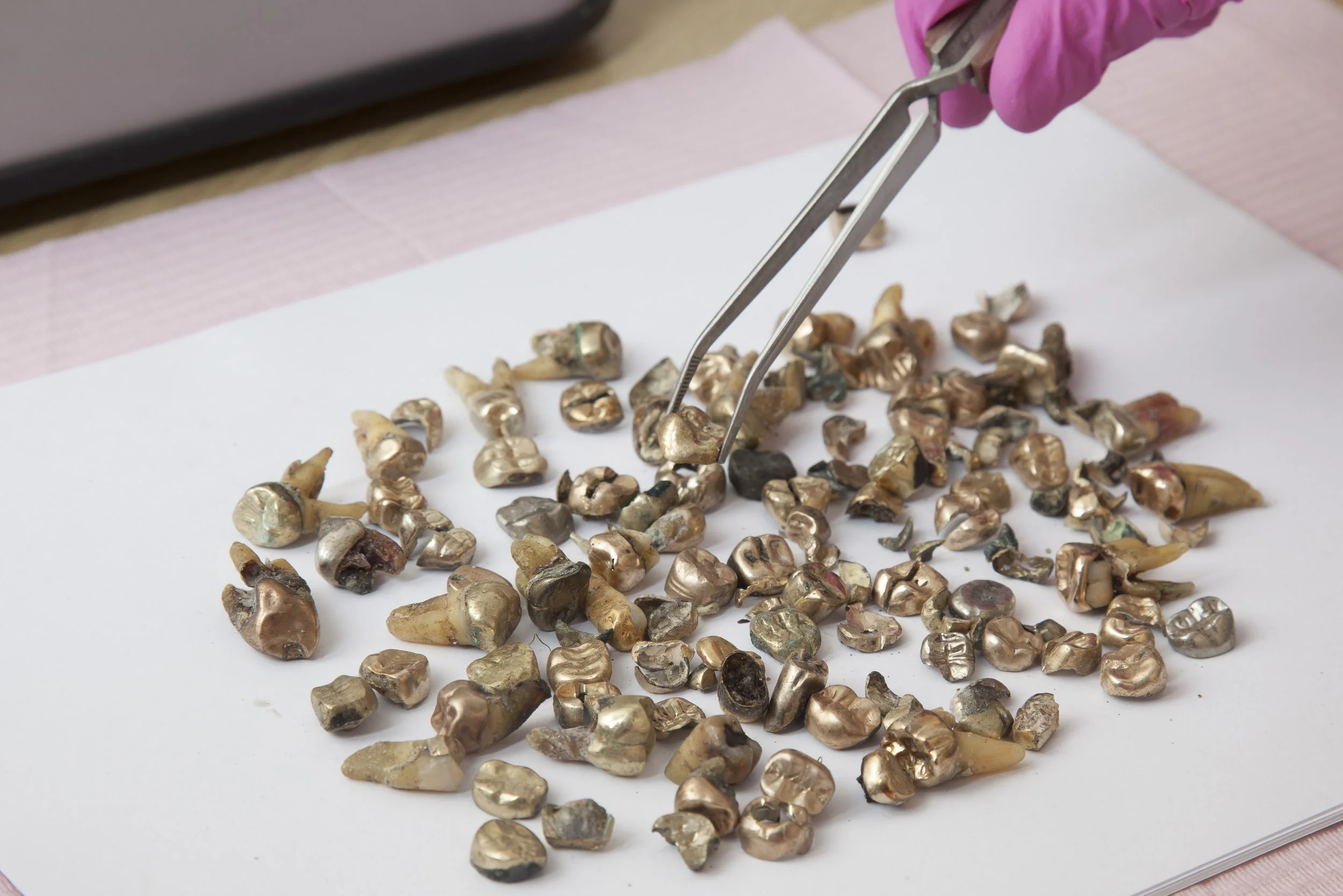 Gold Refining | Dental Scrap | Simple Refining