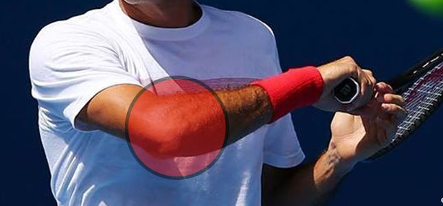 Tennis Elbow — Recharge Sports Injury Center