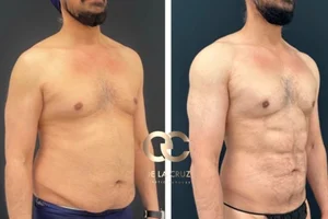 Liposuction Houston - De La Cruz Plastic Surgery