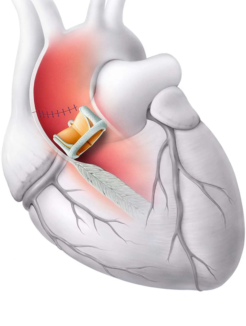 Aortenklappenersatz Icd10 | OPS-2024: Aortenklappe – GVJGVD