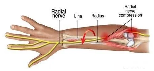 Radial Nerve Entrapment —Physical TheraPT | Comprehensive Athletic Recovery