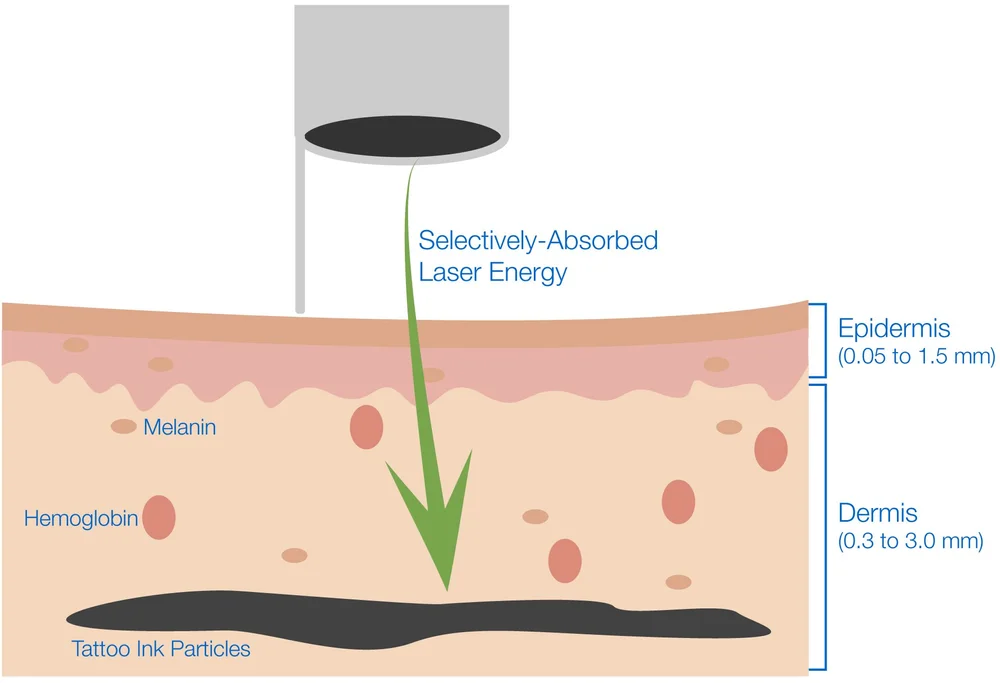 Laser Tattoo Removal Tailored Tattoo Removal Melbourne