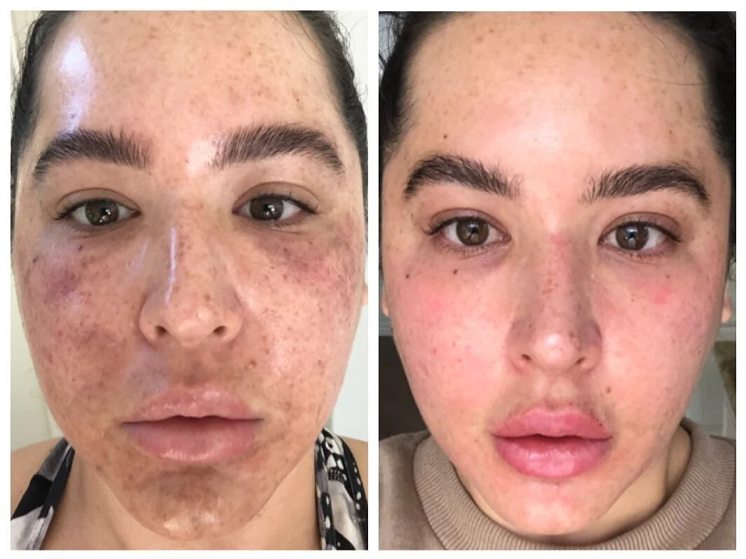 DMK Skin Revision Facial Treatments — Blume Beauty Co. | skin. brows ...