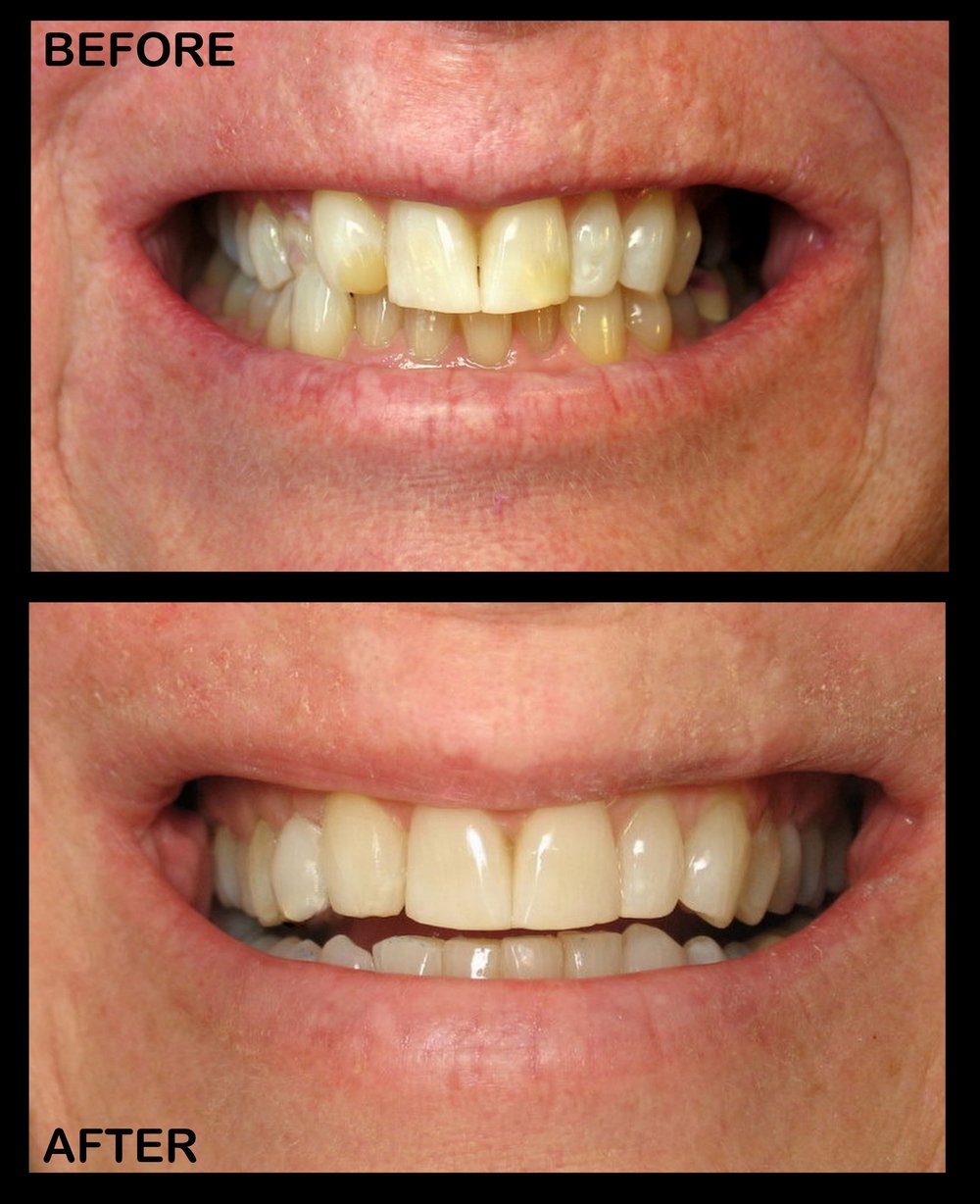 Bad Teeth Before And After