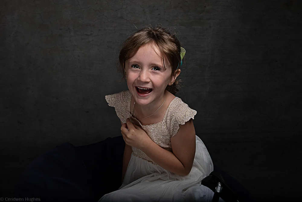 Marfan Syndrome Girl