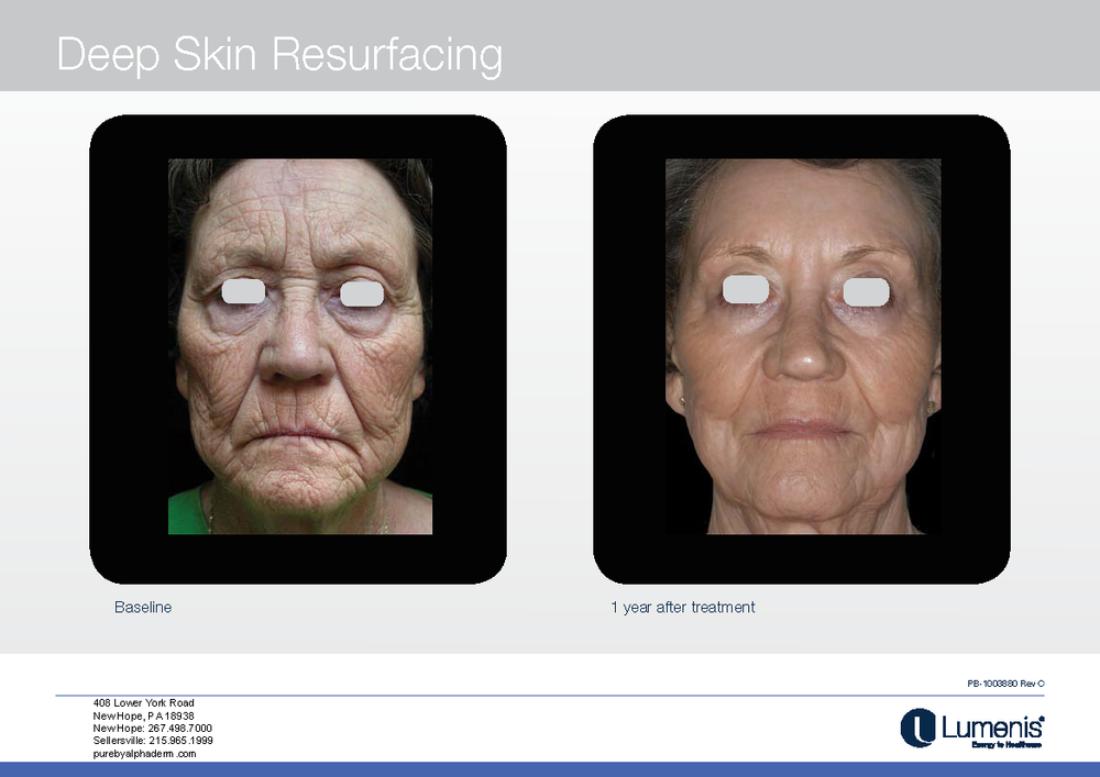 Co2 Laser Resurfacing — Board Certified Dermatology