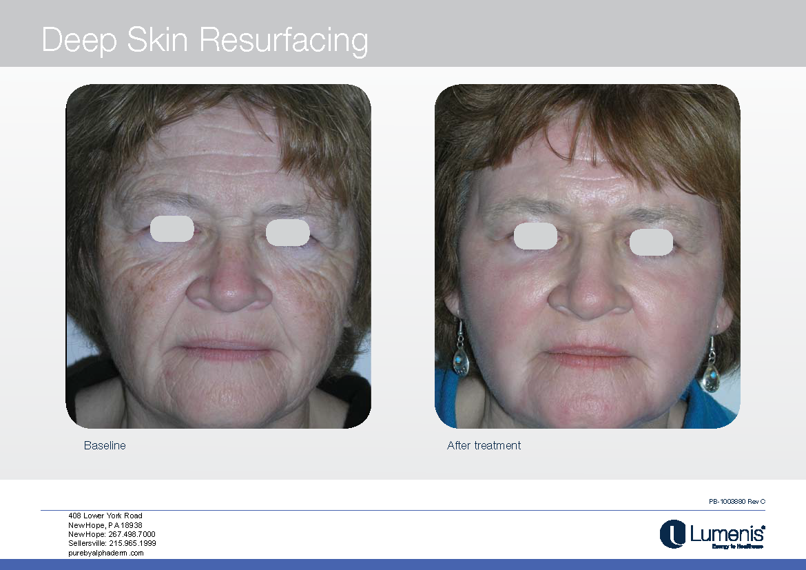 Co2 Laser Resurfacing — Board Certified Dermatology