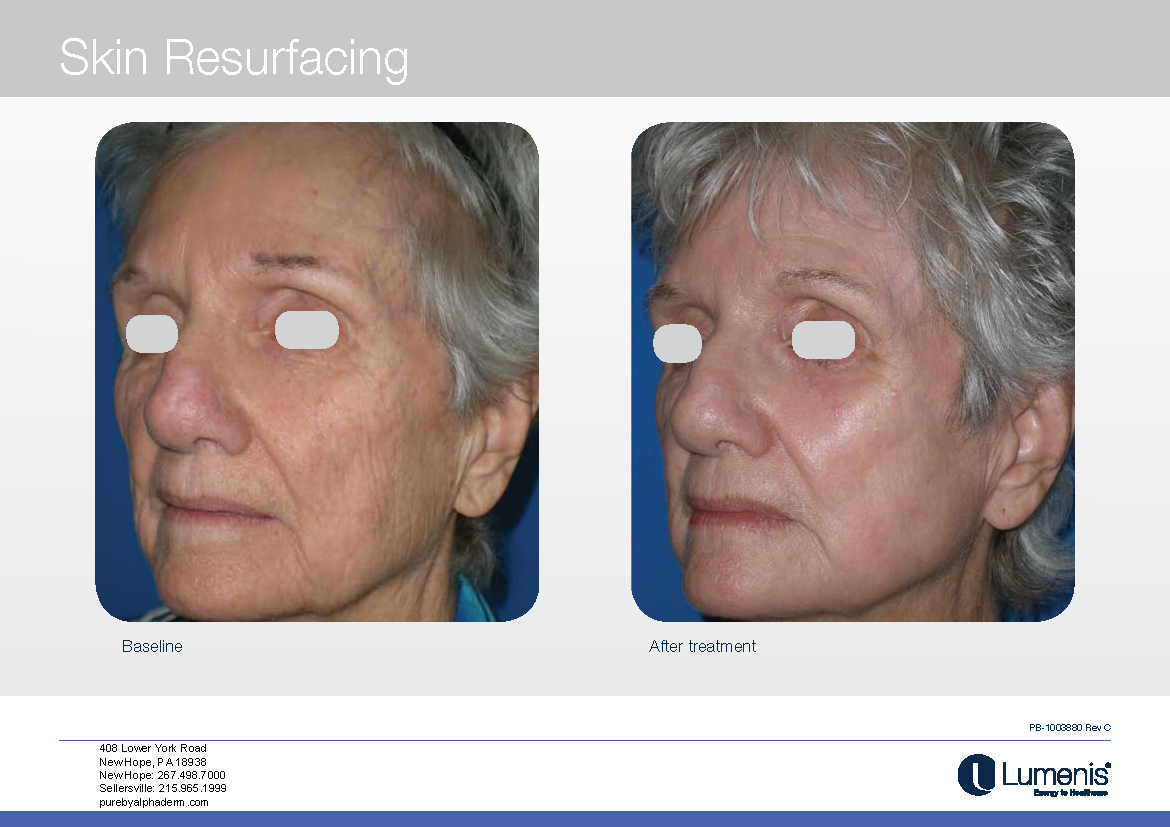 Co2 Laser Resurfacing — Board Certified Dermatology