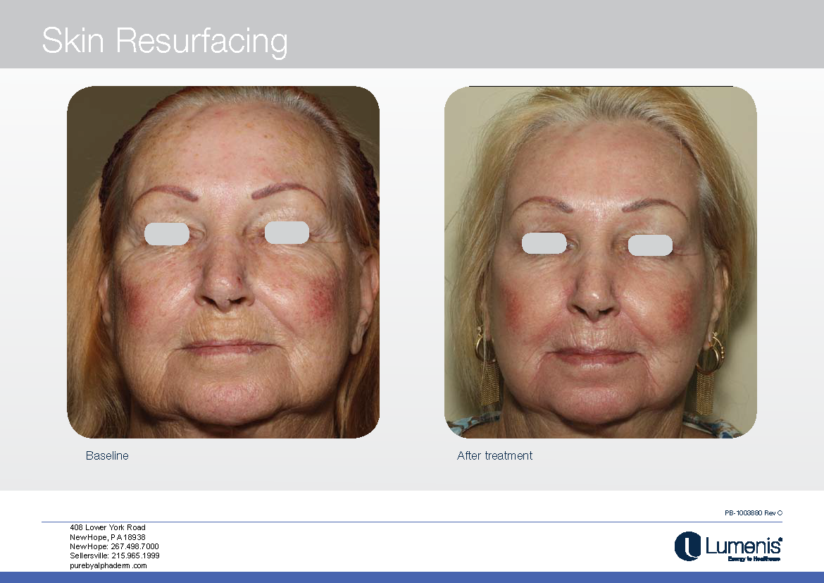 Co2 Laser Resurfacing — Board Certified Dermatology
