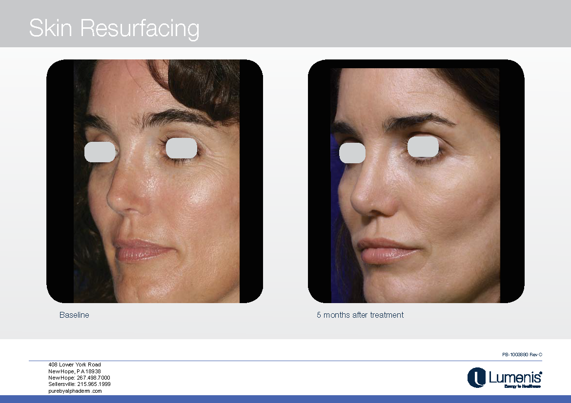 Co2 Laser Resurfacing — Board Certified Dermatology