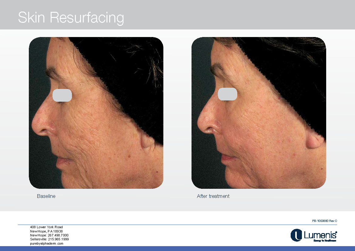 Co2 Laser Resurfacing — Board Certified Dermatology