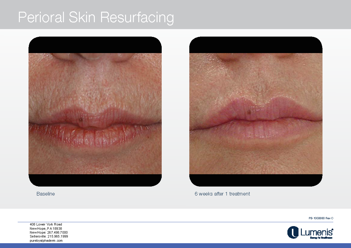 Co2 Laser Resurfacing — Board Certified Dermatology