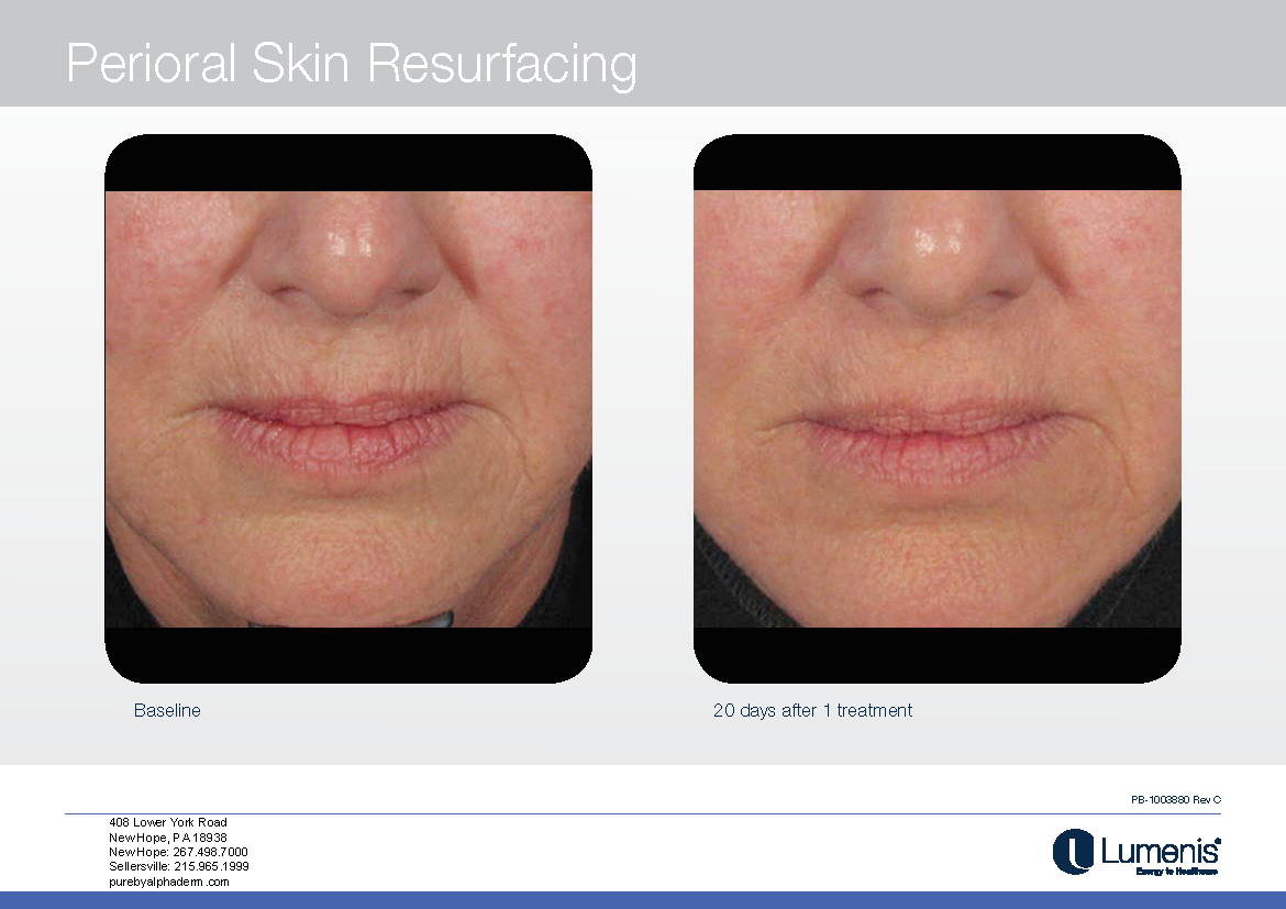 Co2 Laser Resurfacing — Board Certified Dermatology