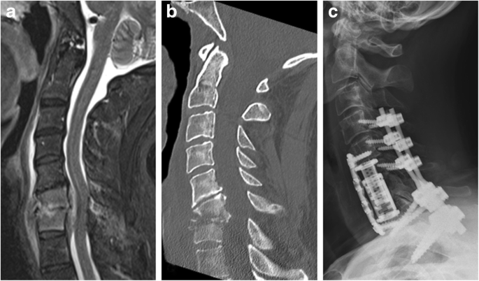 De novo methicillin-resistant Staphylococcus aureus vs. methicillin ...