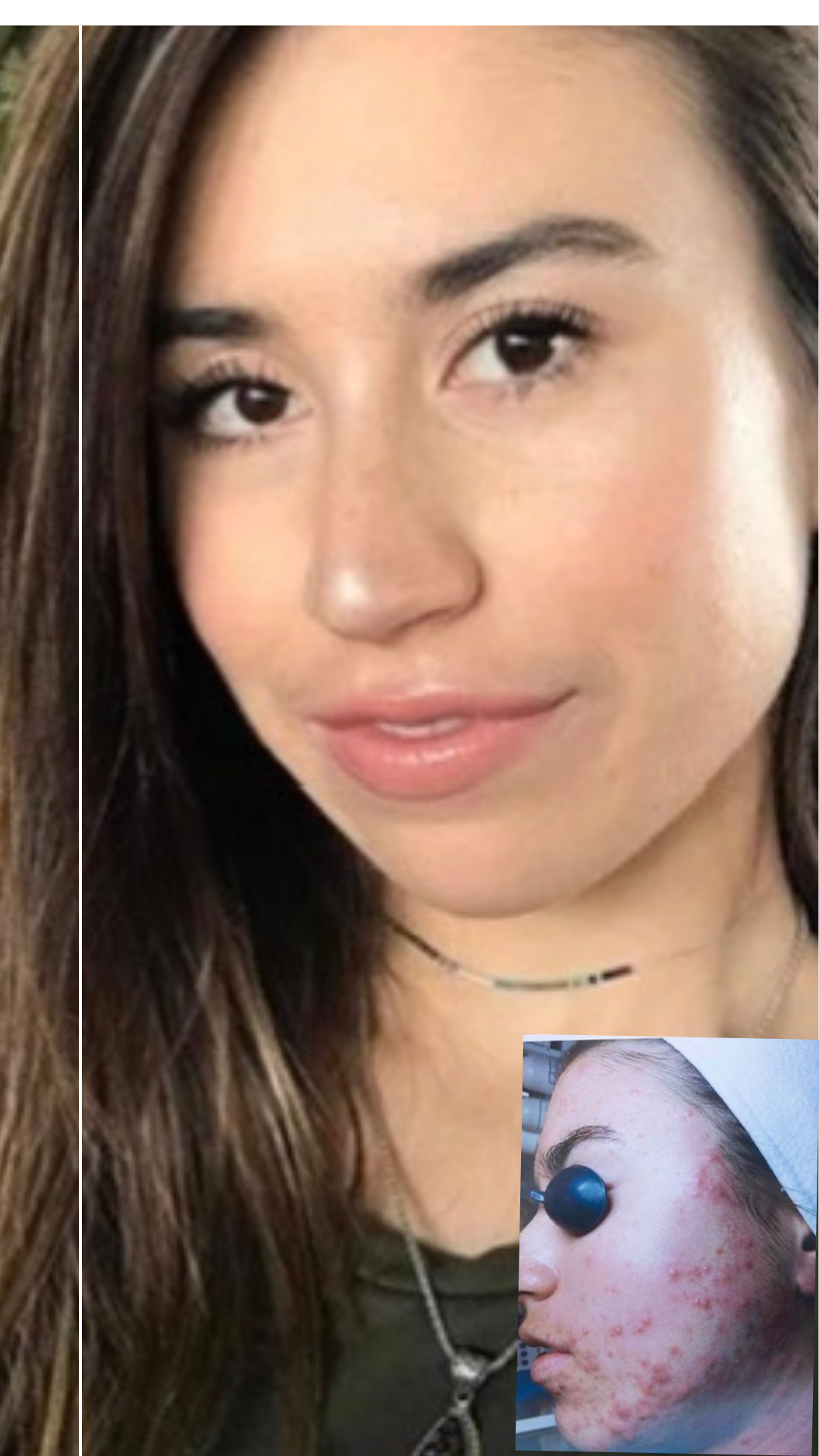 Get Glear Boise, Acne & Anti-Aging