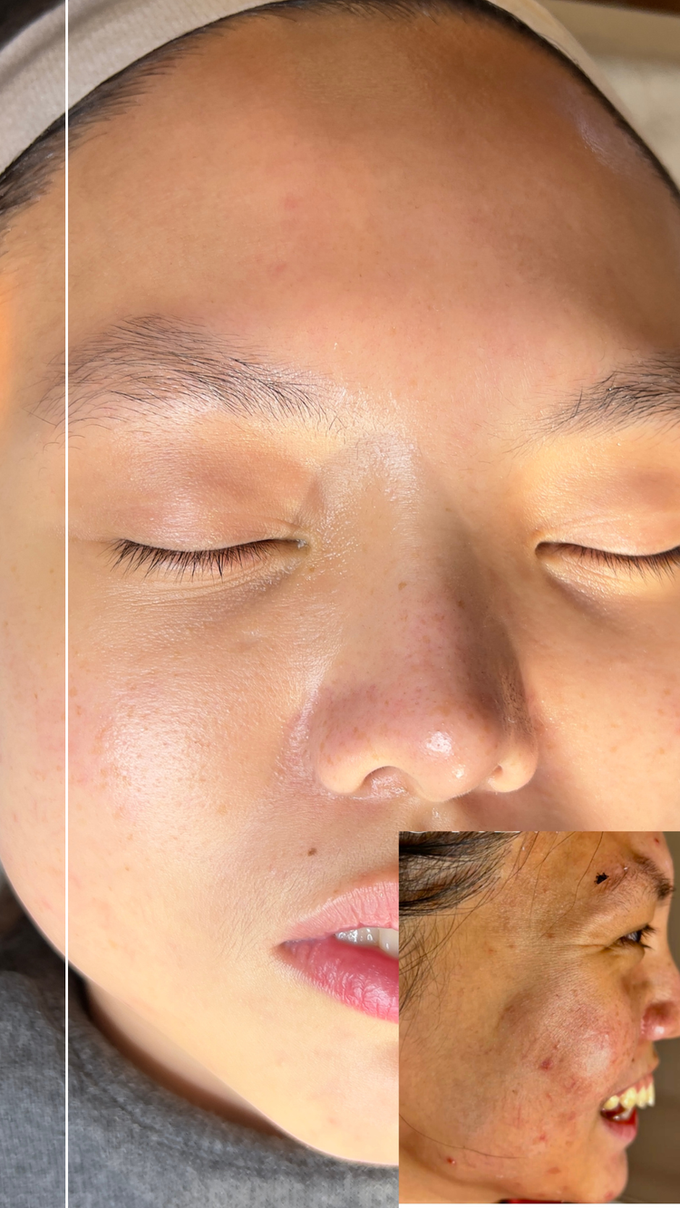 Get Glear Boise, Acne & Anti-Aging