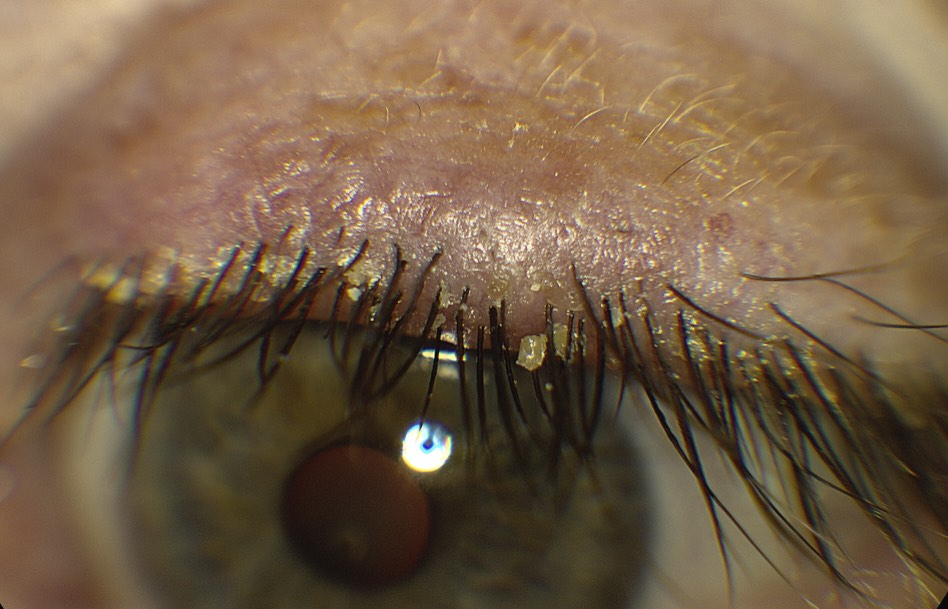 McDonald Adams Optometrists Eyelid Hygiene Options