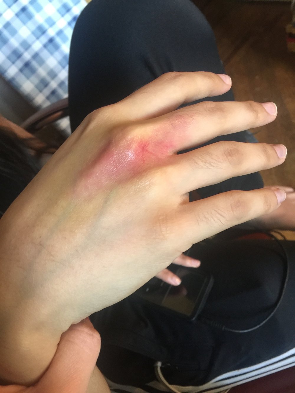 Bruised Knuckles From Punching A Wall