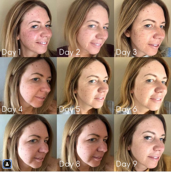 LimeLight Facial — Lakes Dermatology