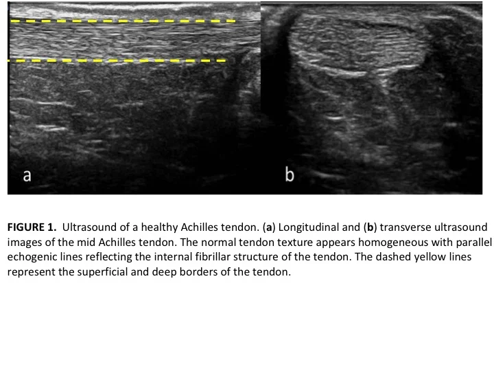 How Important is Imaging for Tendon Pain and Injury? — Mend
