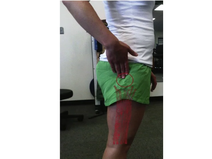 Lateral Hip Pain and Bursitis — Mend