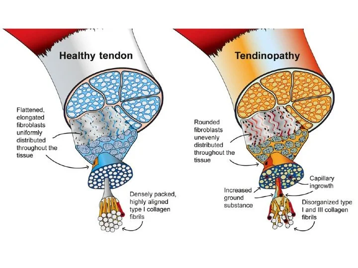 What's the Best Treatment for Tendon Pain in Rock Climbers? — Mend