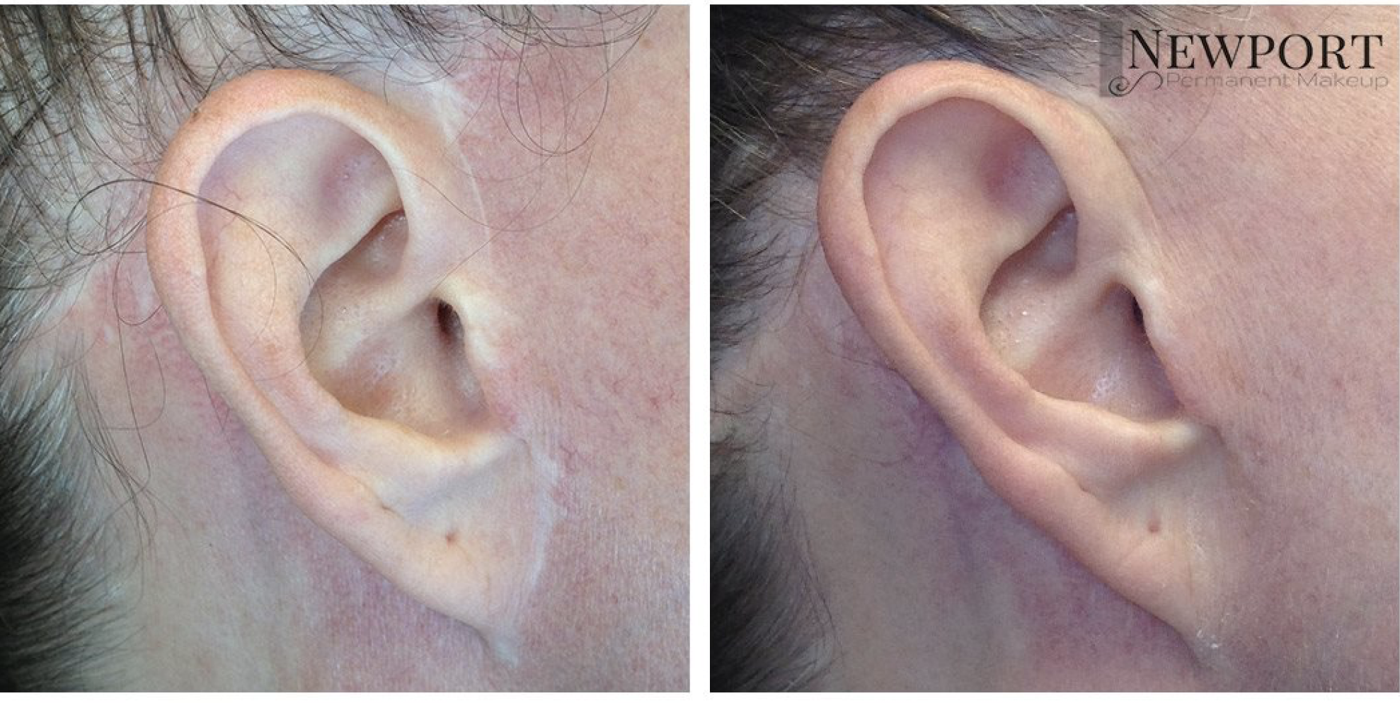 Permanent Makeup Scars | Saubhaya Makeup