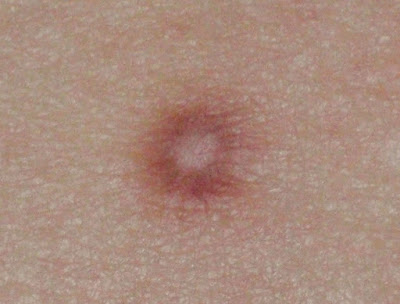 Dermatofibroma — Dr. Michelle Levy