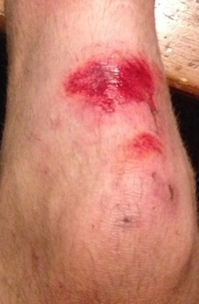 Cycling Road Rash; Wound Care Bonus Edition — Pedal Fit