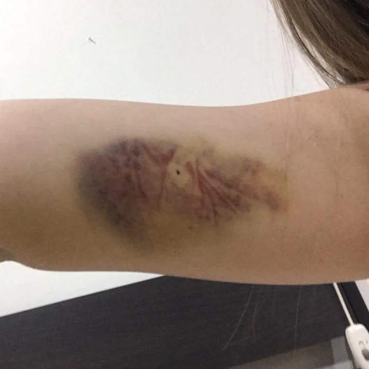 Contraceptive Implant Bruising