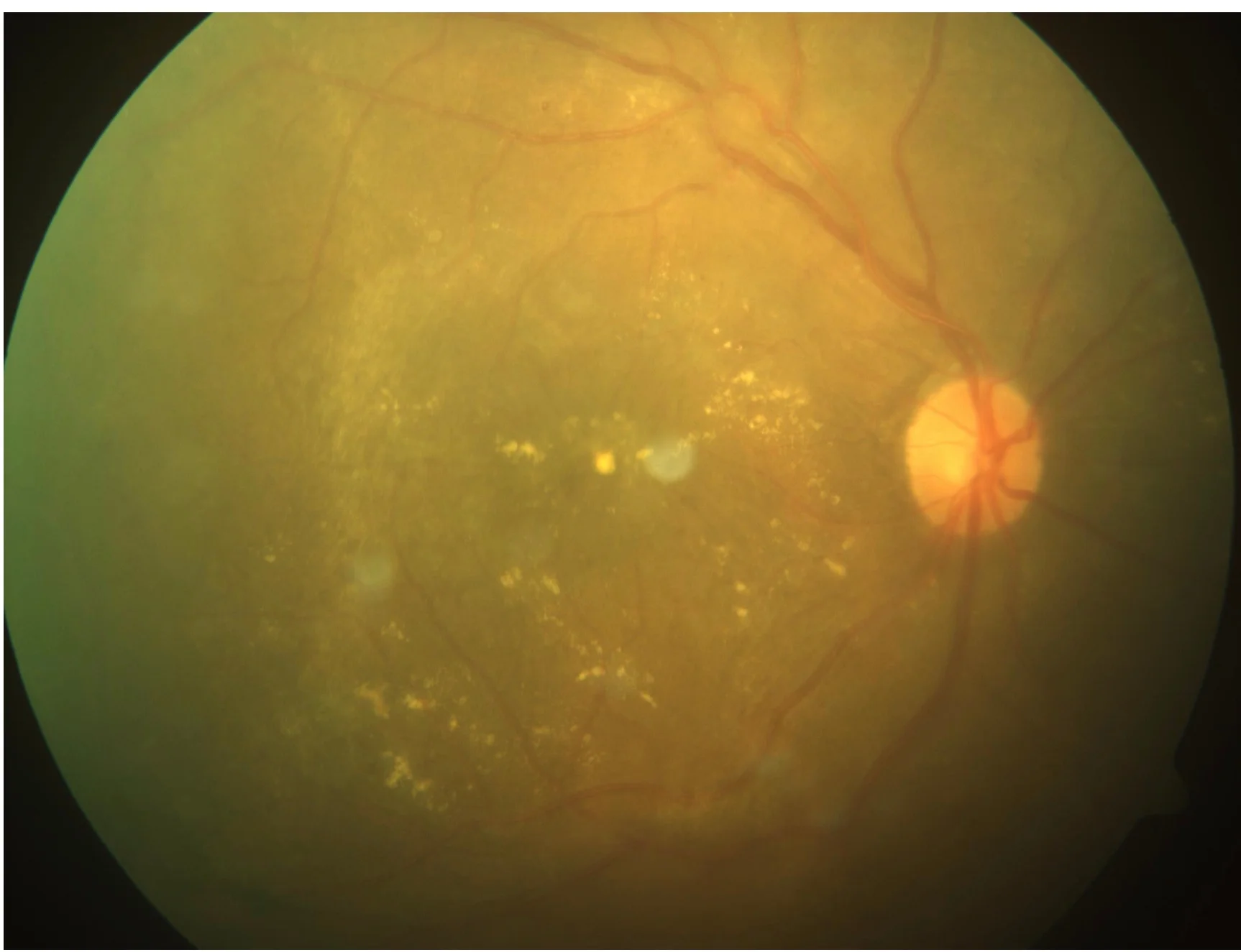 Open Indirect Ophthalmoscope — L V Prasad Eye Innovations