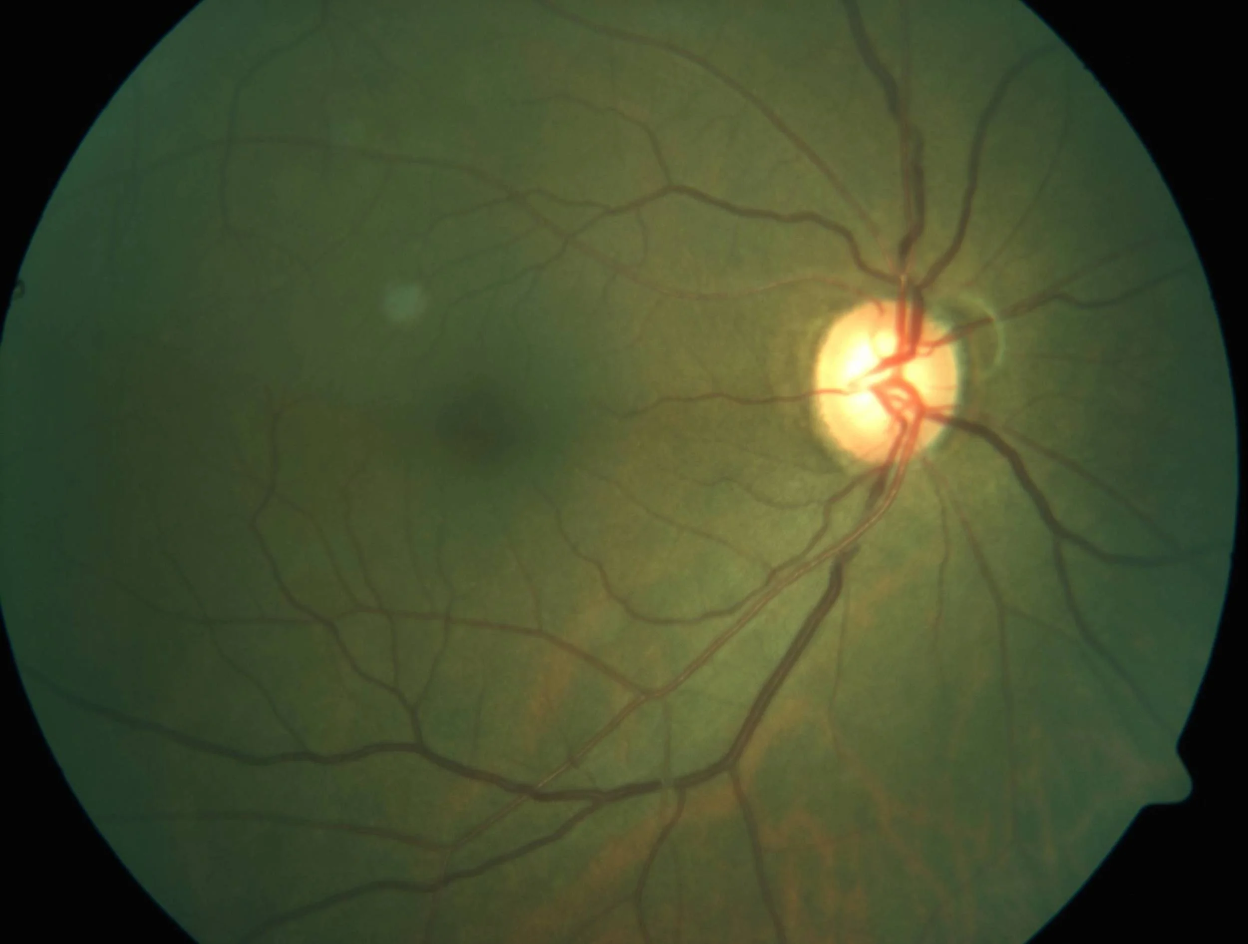 Open Indirect Ophthalmoscope — L V Prasad Eye Innovations