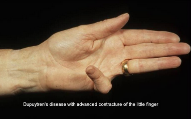 Dupuytren's Disease — The Manchester Hand Clinic