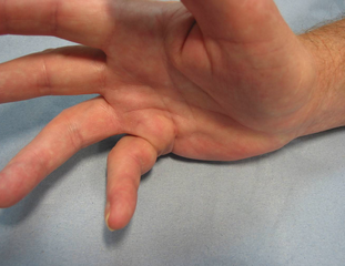 Dupuytren's Disease — The Manchester Hand Clinic