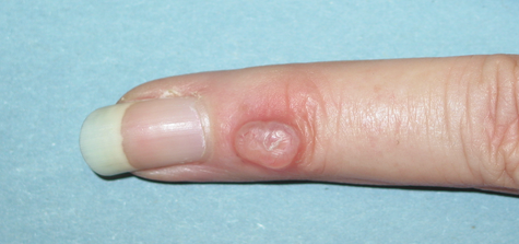 Mucous cyst — The Manchester Hand Clinic