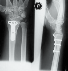 Wrist fractures — The Manchester Hand Clinic
