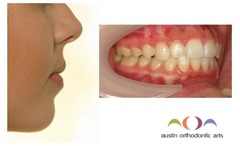 Can Braces Make Your Lips Stick Out | Lipstutorial.org