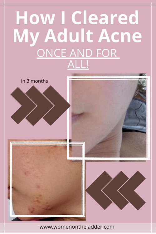 How I Cleared my Adult Acne Once And For All! — Women On The Ladder