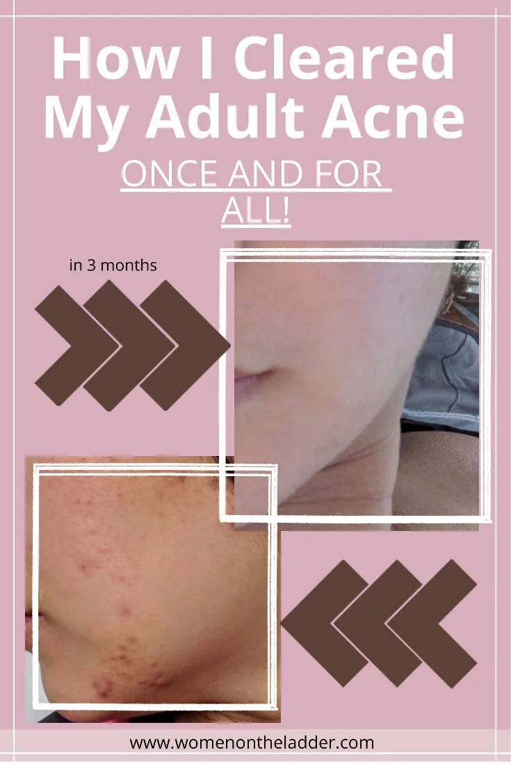 How I Cleared my Adult Acne Once And For All! — Women On The Ladder