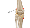 Radiofrequency Ablation (Knee Joint) — Alliance Pain center