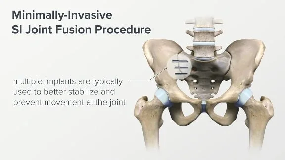 SI Fusion — Alliance Pain center